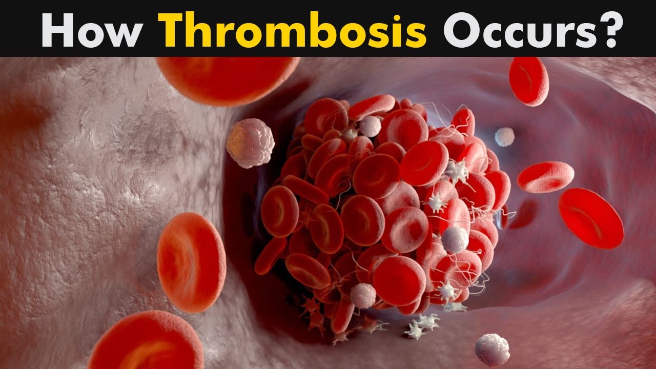 Thrombosis 3D Animation Deep Vein Thrombosis Symptoms Causes And Thrombosis 3D Animation Deep Vein Thrombosis Symptoms Causes And