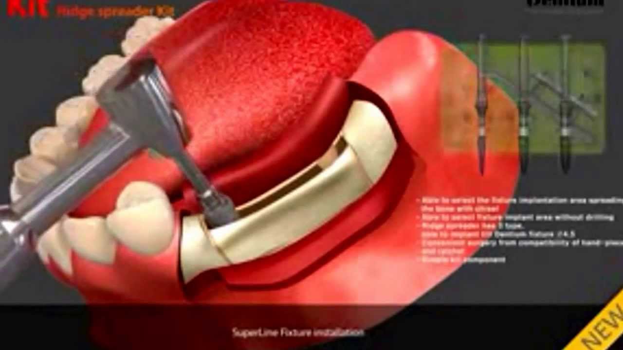RS kit (Ridge Spreader) | Dentium - YouTube