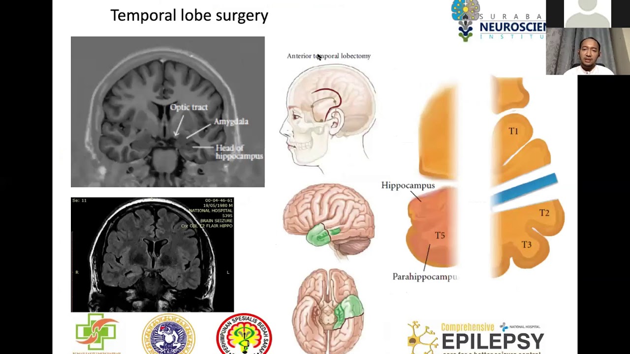 Neurosurgery Webinar Class || Temporal Lobe Epilepsy Surgery ...