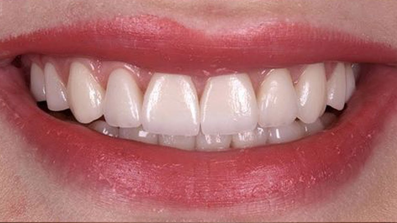 Como Limpar uma PPR Prótese Dentária Removível? - YouTube