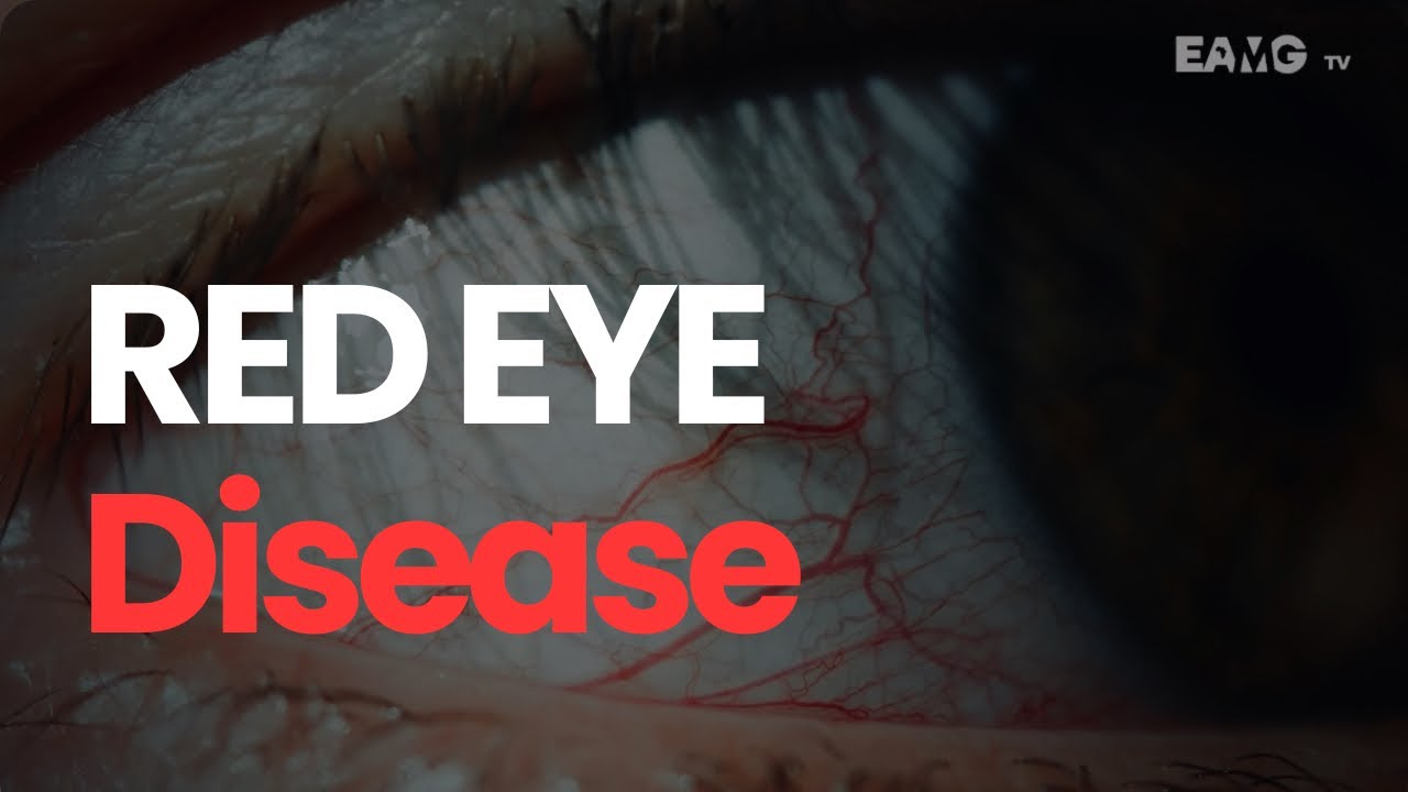 EXPLAINER: The Red Eye Disease: Please don't ignore! - YouTube