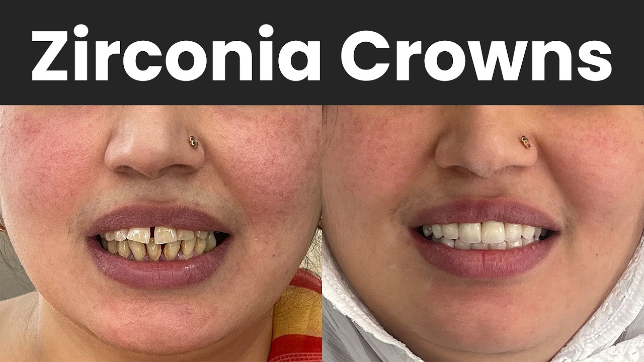 Zirconium Crowns Procedure Before & After | Treatment of Complex ...