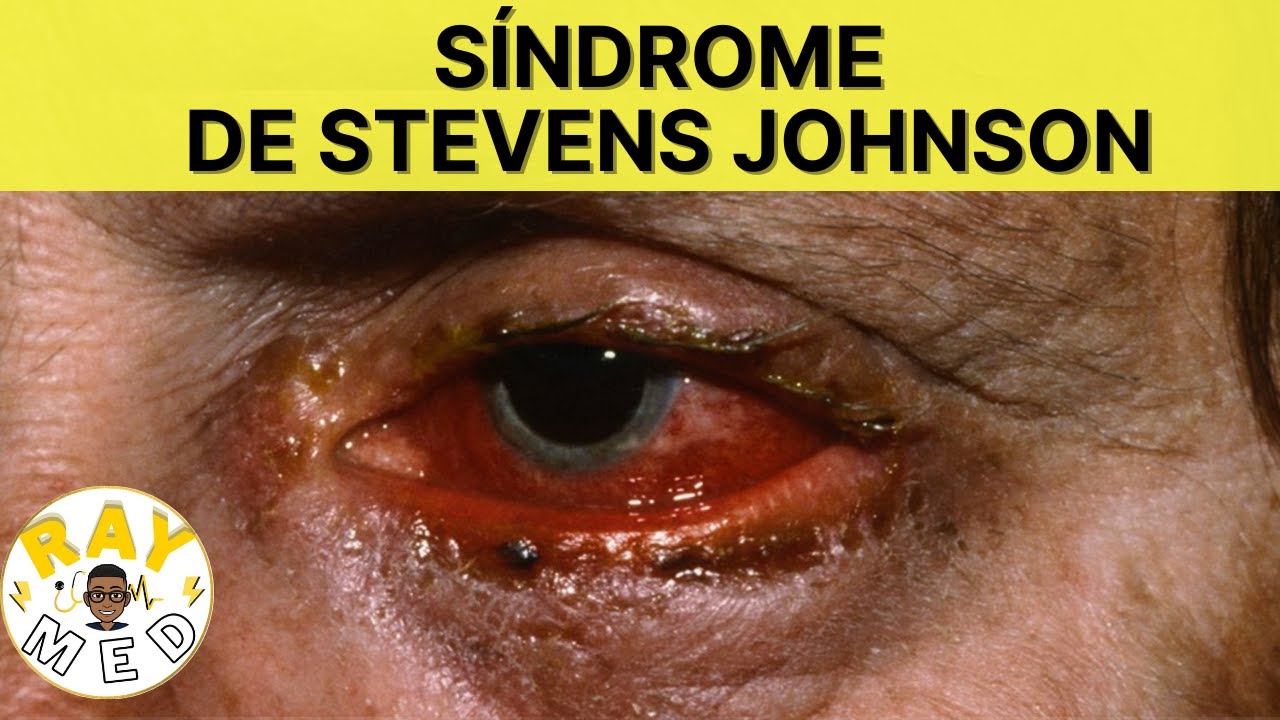 Sindrome de Stevens Johnson | Definición, Etiología y Fisiopatología - YouTube