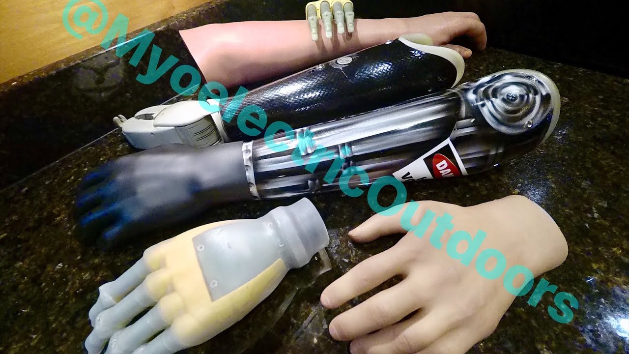 Amputee: How I Use My High Tech Prosthetic Hand - YouTube