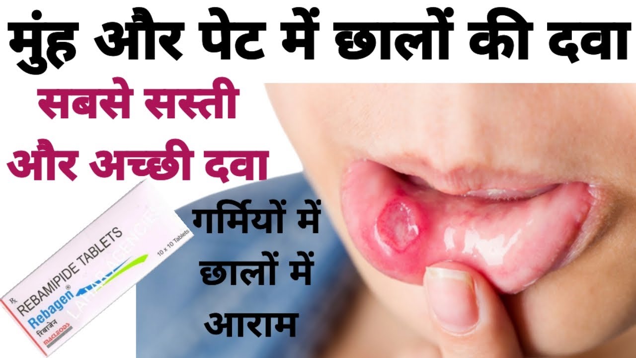 मुंह में छालों की दवा |mouth ulcer treatment |rebagen tablet | lexanox ...