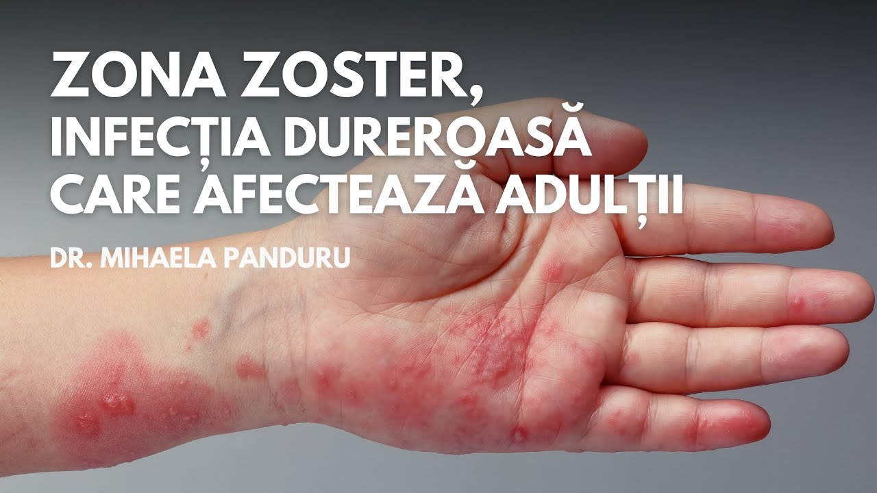 ZONA ZOSTER, infecția dureroasă care afectează adulții | Dr. Mihaela ...