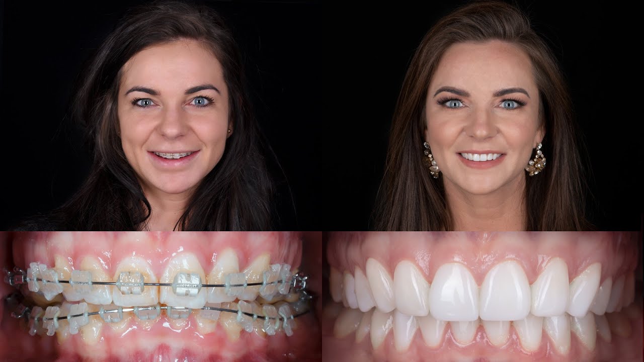 CHCIAŁAM ŻEBY ZĘBY BYŁY ŁADNE, PROSTE I BIAŁE! BONDING METODĄ FLOW ...