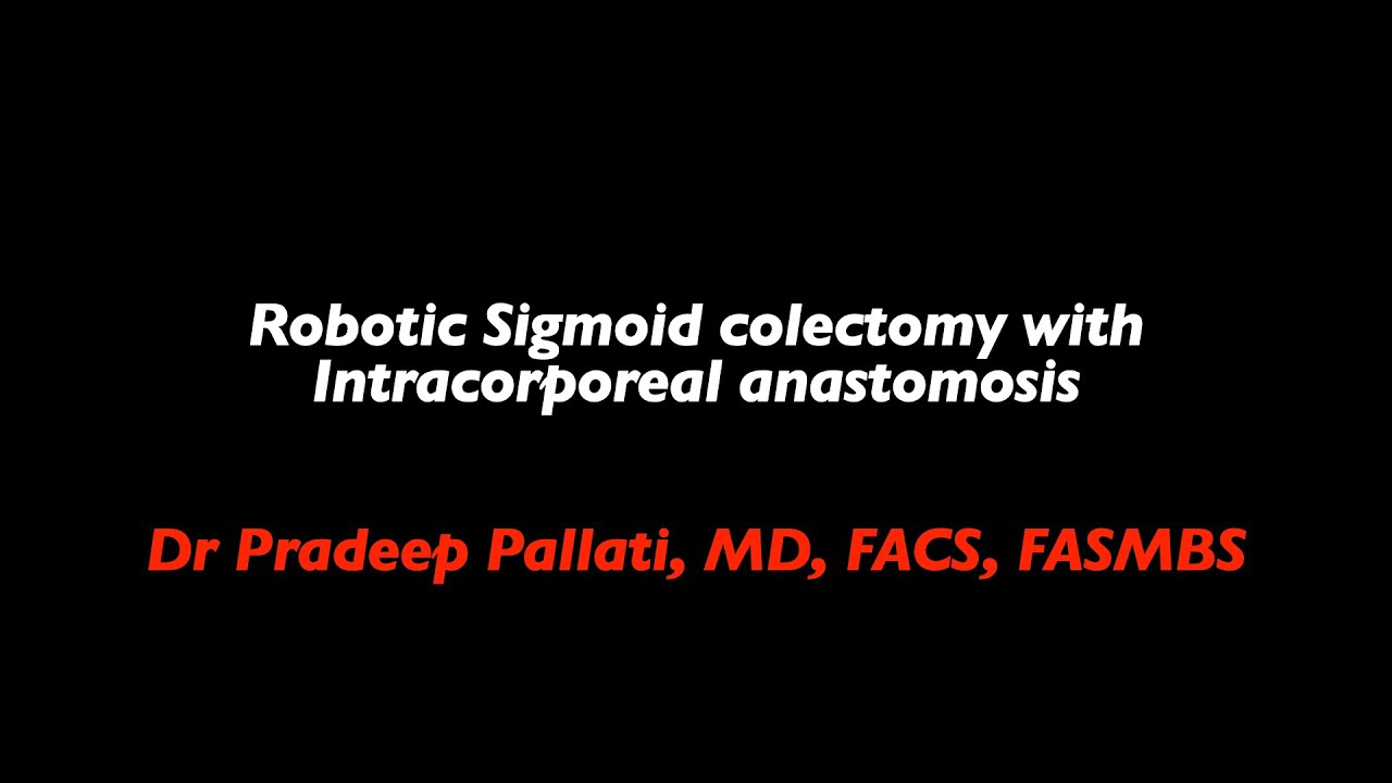 Robotic sigmoid colectomy with Intracorporeal anastomosis - YouTube