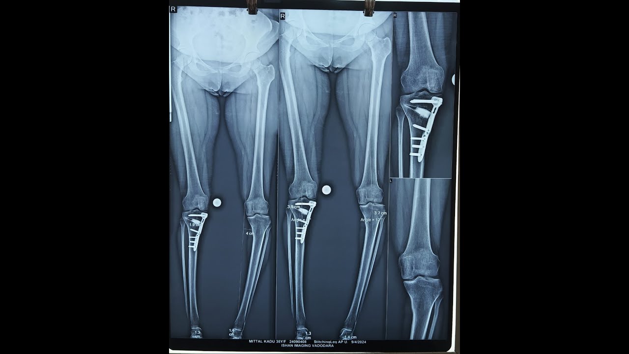 HTO- HIGH TIBIAL OSTEOTOMY - YouTube