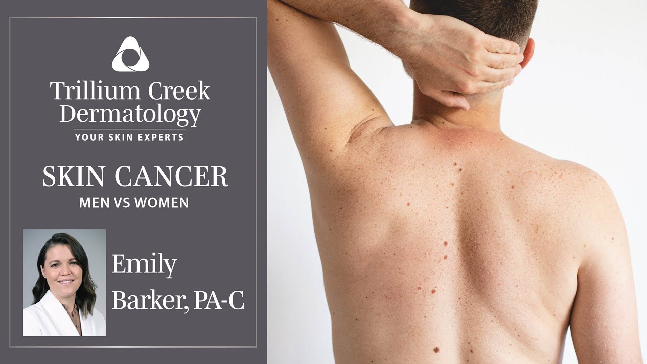 Men and Women Skin Cancer Differences - YouTube