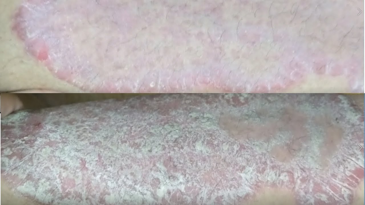 PSORIASIS FLAKES ENSUE - YET HOPE SHINES THROUGH - YouTube