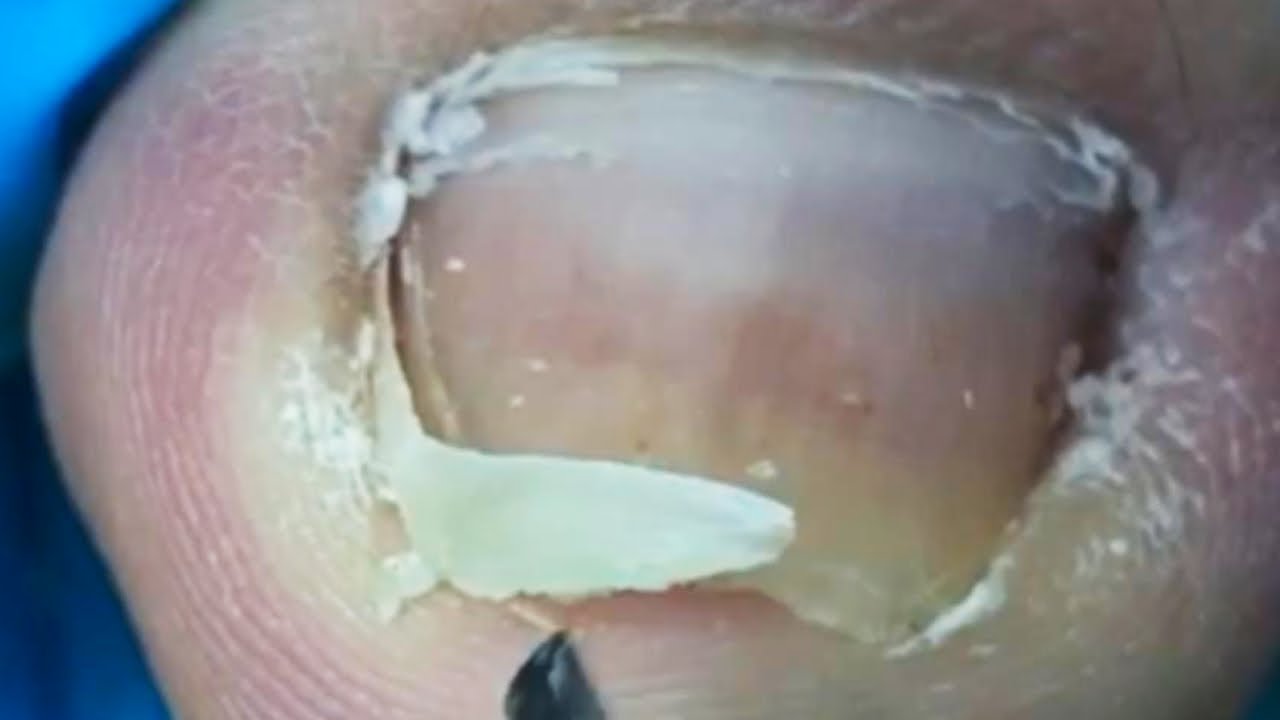 Remove Excess Ingrown Toenails And Dead Skin - YouTube