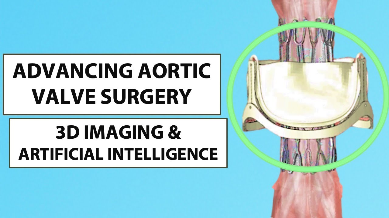 Patient Webinar: Advances in Aortic Valve Surgery with 3D Imaging ...