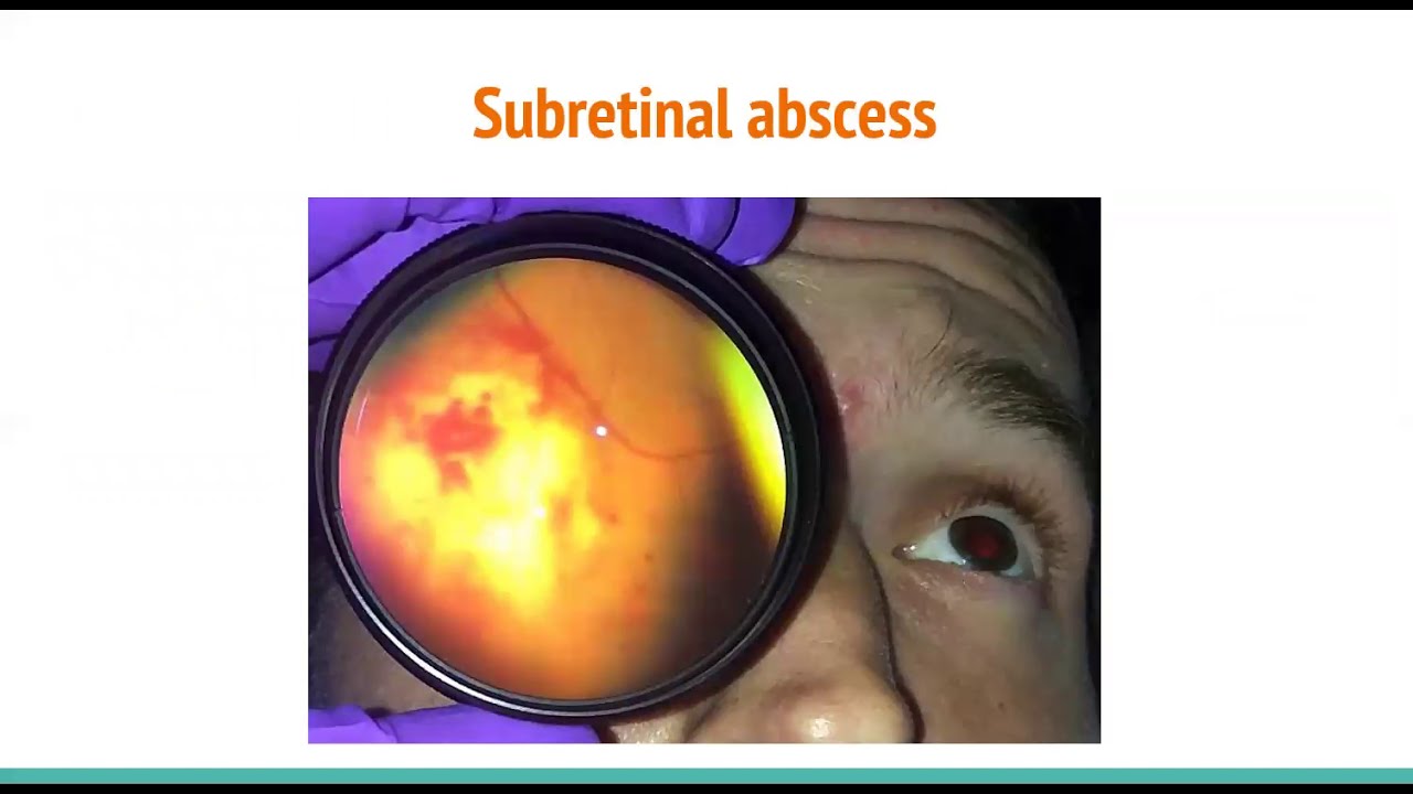 Case Reports: Subretinal Abscess - YouTube