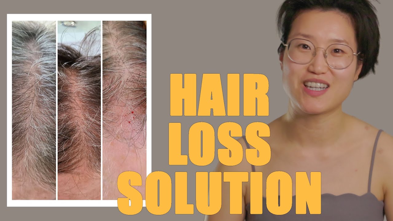 How to grow hair naturally and stop a receding hairline - Home remedy ...