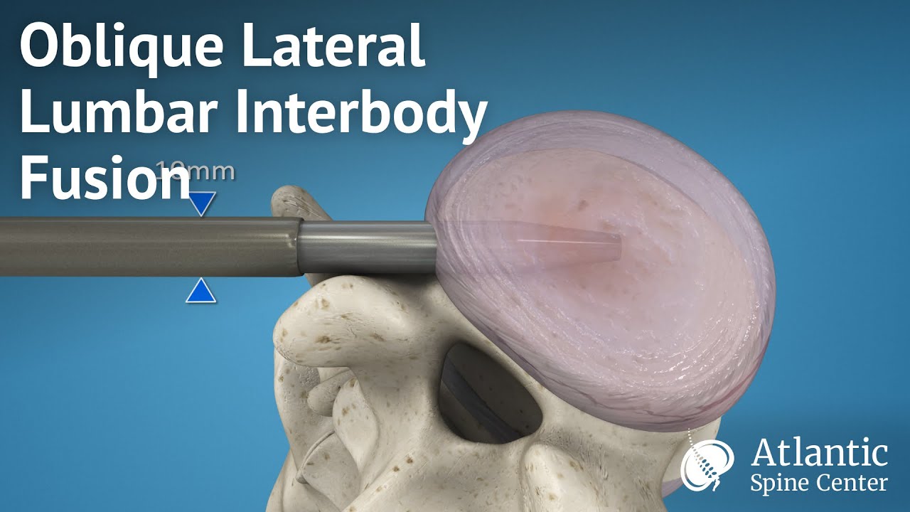 Oblique Lateral Lumbar Interbody Fusion (OLLIF) - YouTube