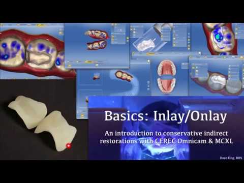 Basics of Inlays and Onlays - Conservative Indirect Restoration with ...