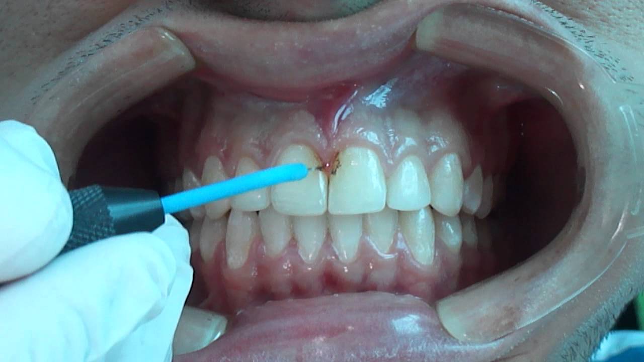 NIVELACIÓN DE MARGENES GINGIVALES Y CONTORNEO - YouTube