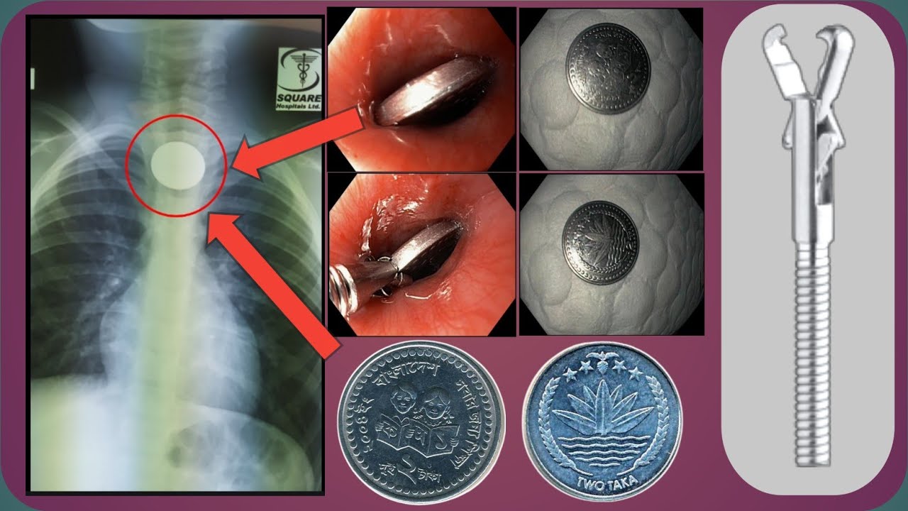 Pediatric Foreign Body Removal Of Coin শিশুর খাদ্যনালী থেকে টাকার কয়েন ...