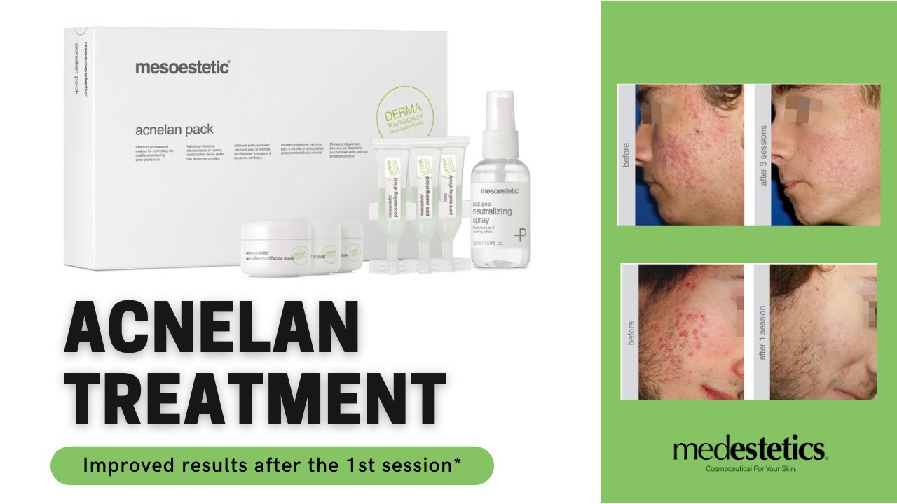 Why Acnelan is the BEST peeling for acne? - YouTube