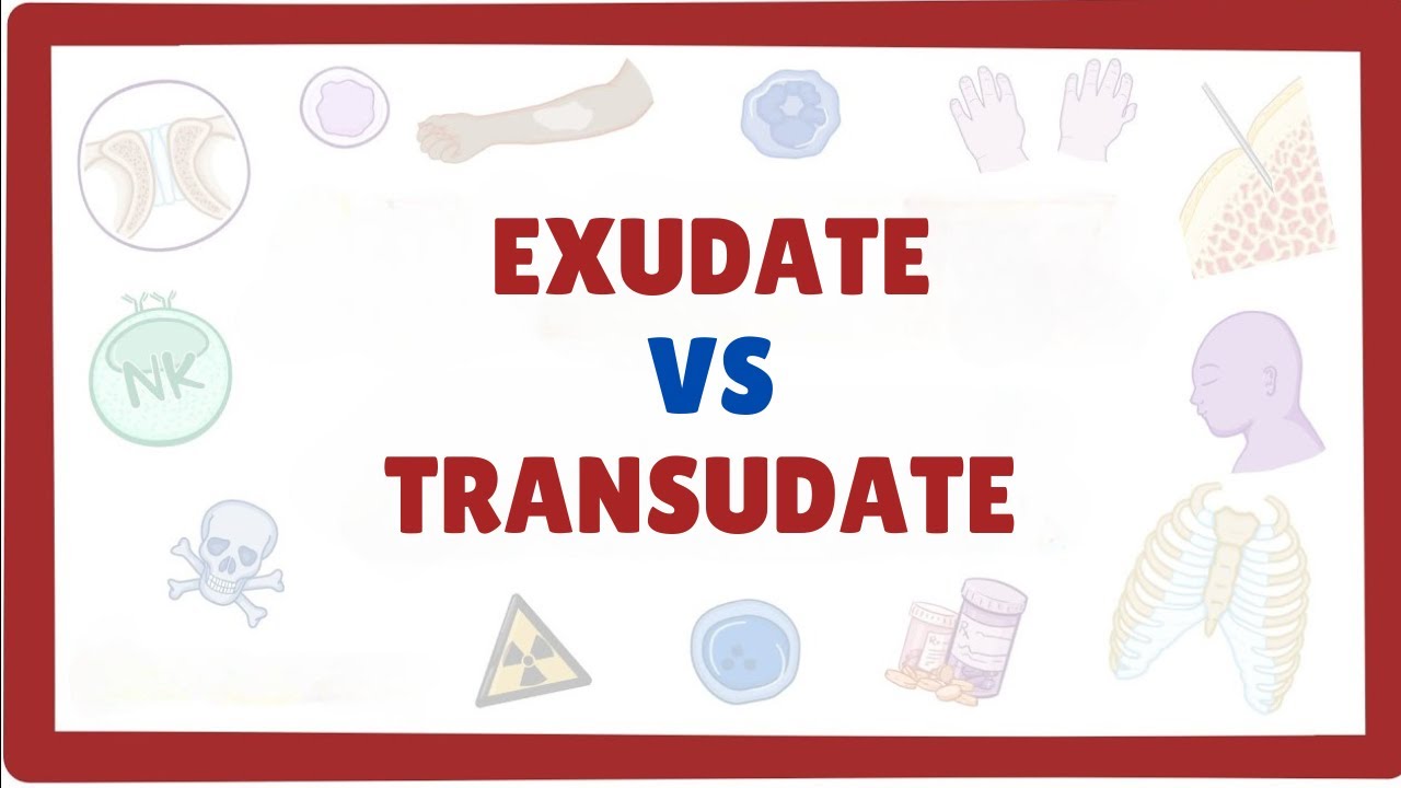 Exudate vs Transudate | exudative vs Transudative pleural effusion ...