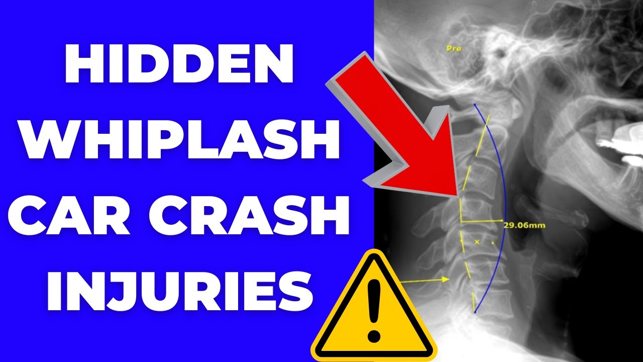 The Hidden Neck Injury After a Car Crash, WHIPLASH (Why X-Rays & MRIs ...