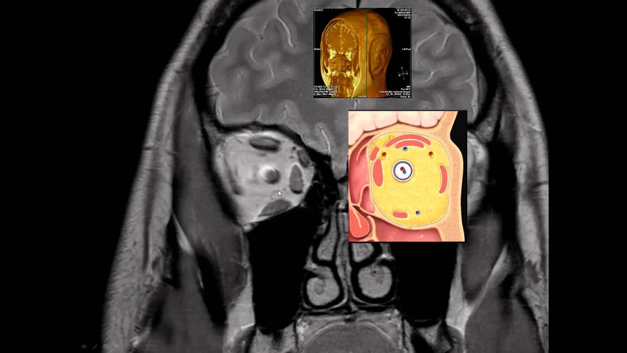 Radiology for Optometrist and Ophthalmologist - YouTube