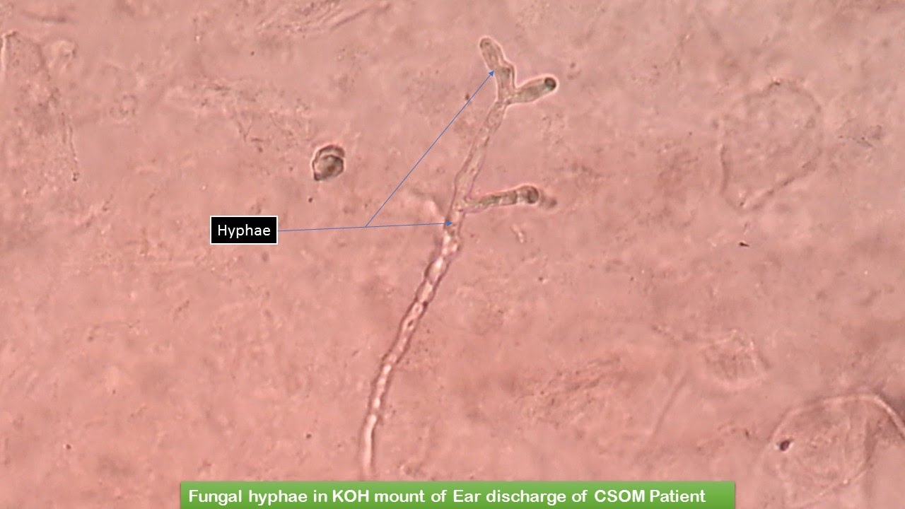 Fungal Hyphae in KOH mount of Pus discharge - YouTube