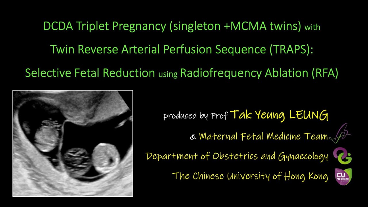 TRAPS in DCDA Triplet pregnancy reduced by RFA - YouTube