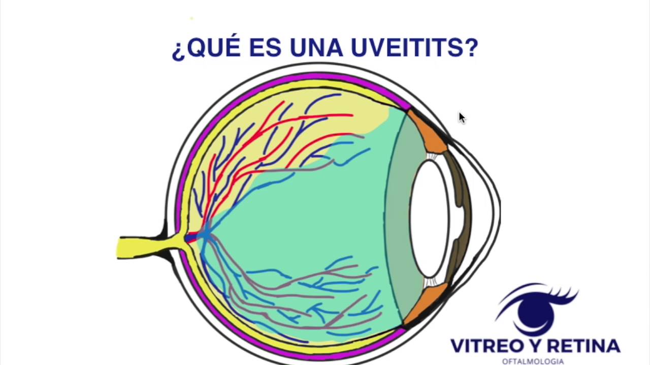 Que es una Uveítis - YouTube