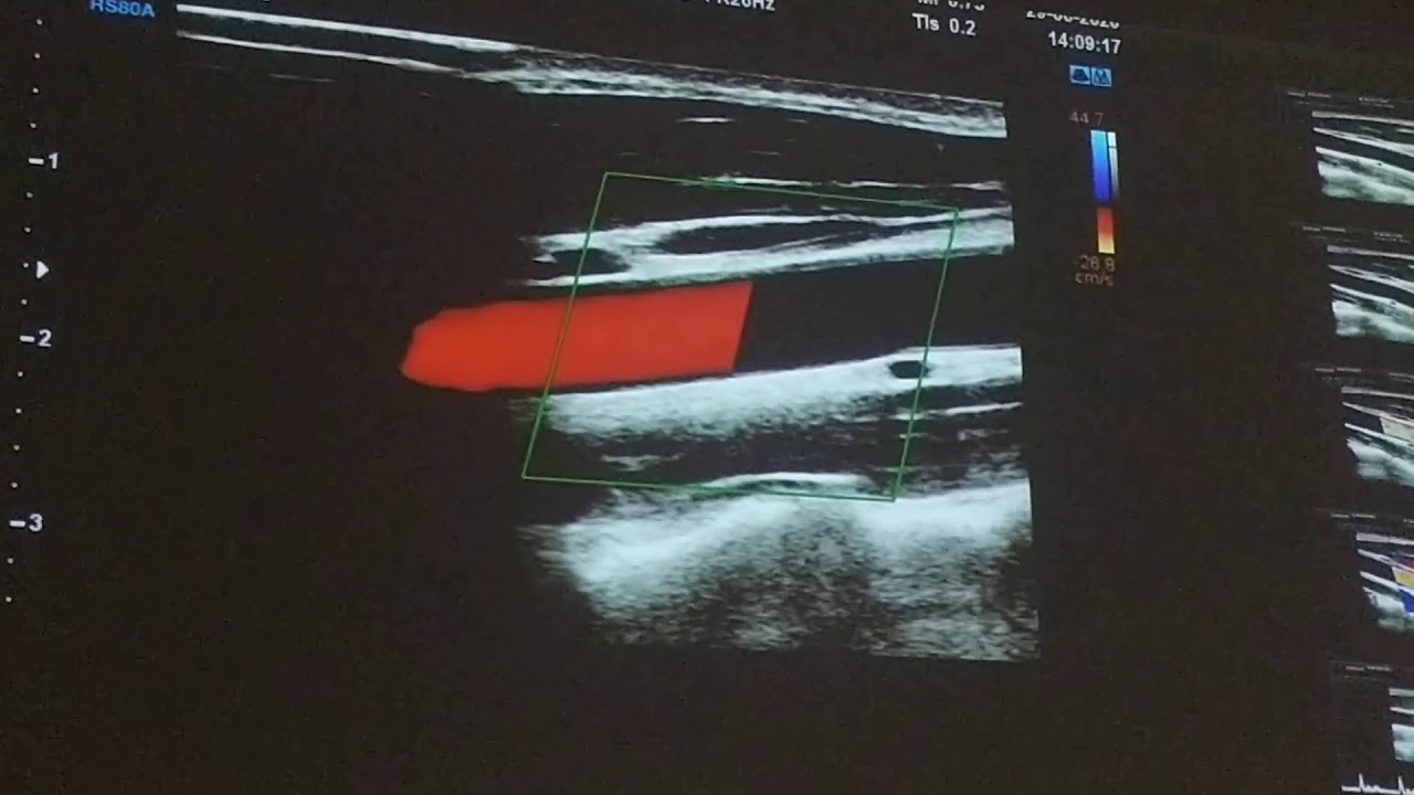 HD doppler 2 - YouTube