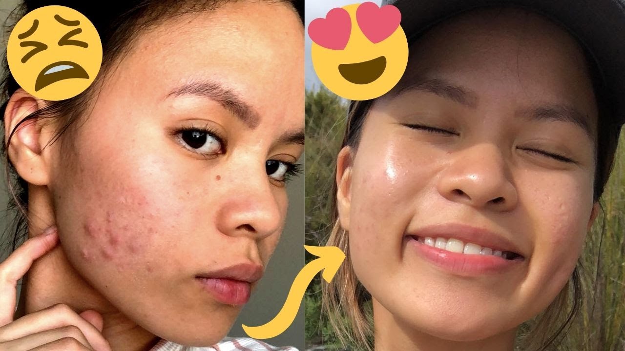 How I Healed My Acne In 10 Days Youtube