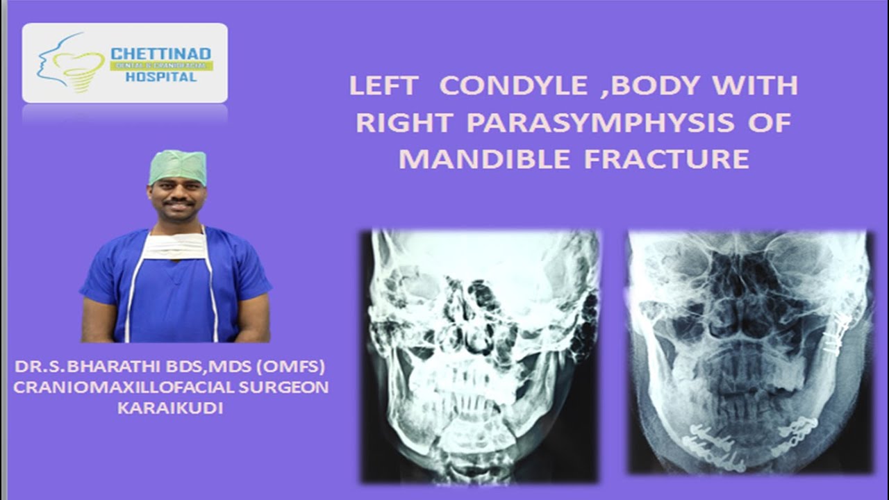 LEFT CONDYLE ,BODY WITH RIGHT PARASYMPHYSIS OF MANDIBLE FRACTURE - YouTube
