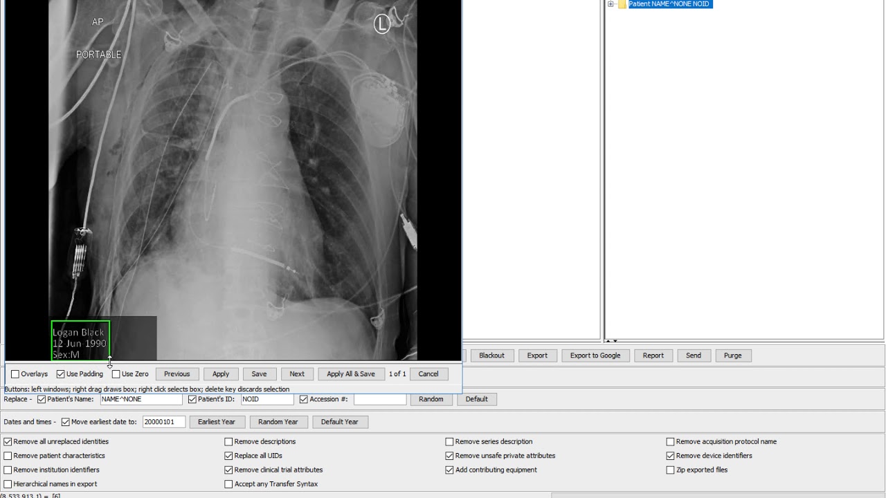 dicom cleaner demo - YouTube
