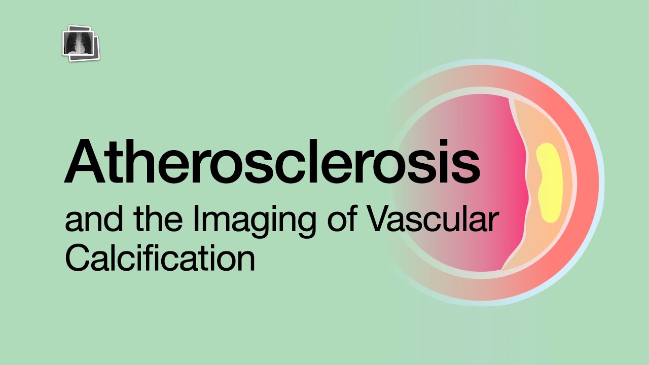 Atherosclerosis & the Imaging of Vascular Calcification - YouTube