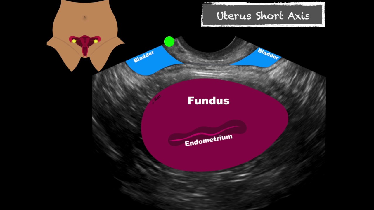 POCUS Female Pelvis Transvaginal Scanning Sequence - YouTube