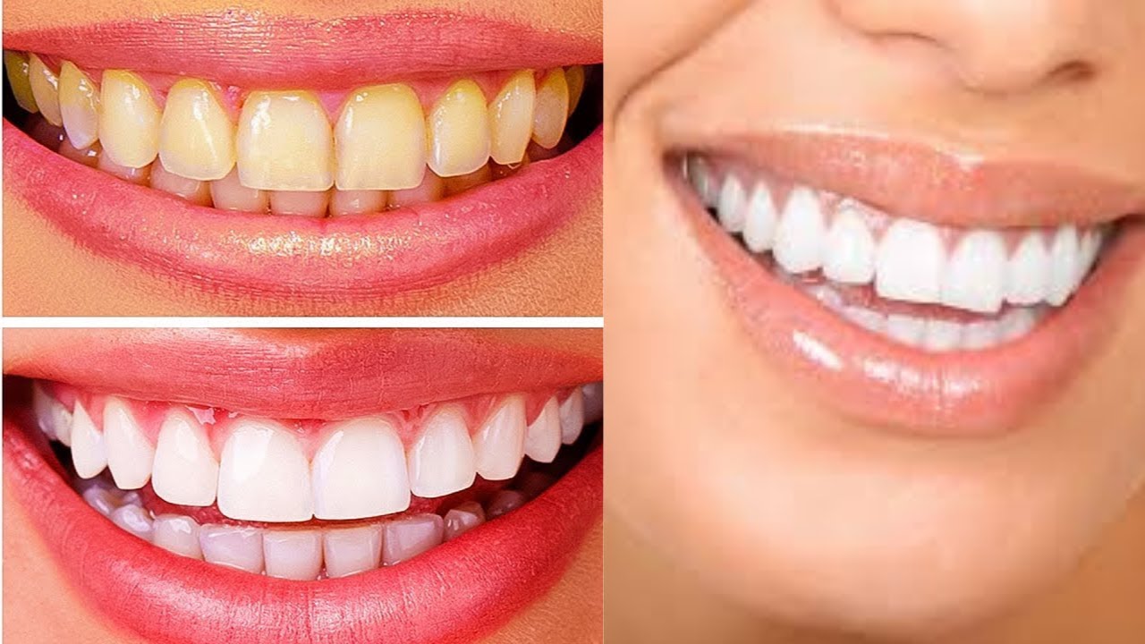 Teeth Whitening At Home In 3 Minutes || How To Whiten Your Yellow Teeth ...