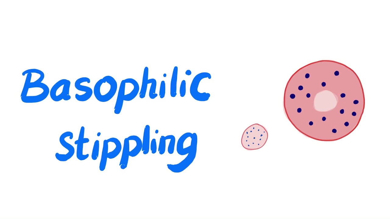 Basophilic Stippling of RBCs - Lead Poisoning - Microscopic Finding ...