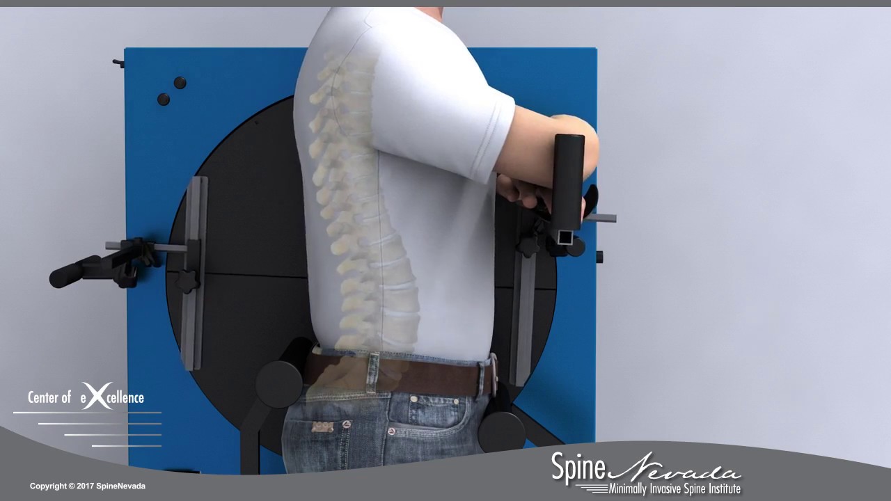 View spinal motion like a movie — Vertebral Motion Analysis (VMA) for ...