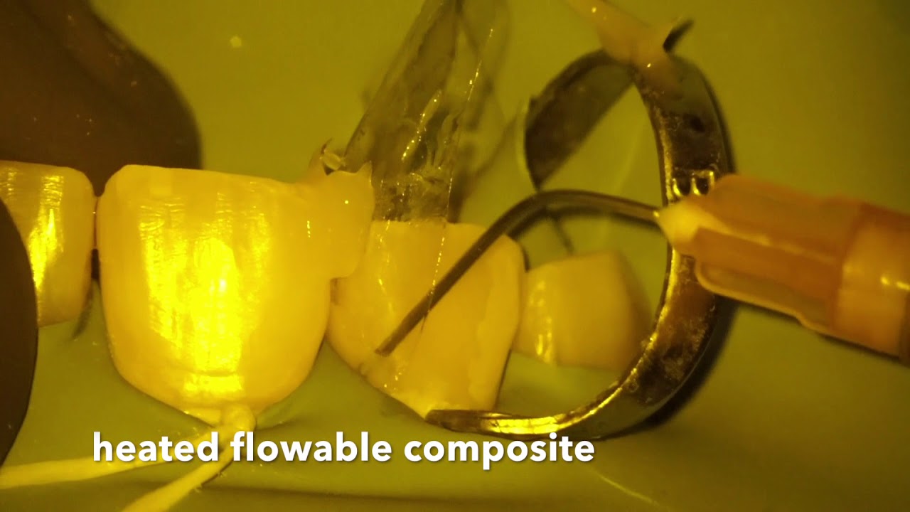 closing spacies using bioclear matrix and injection molding technique ...