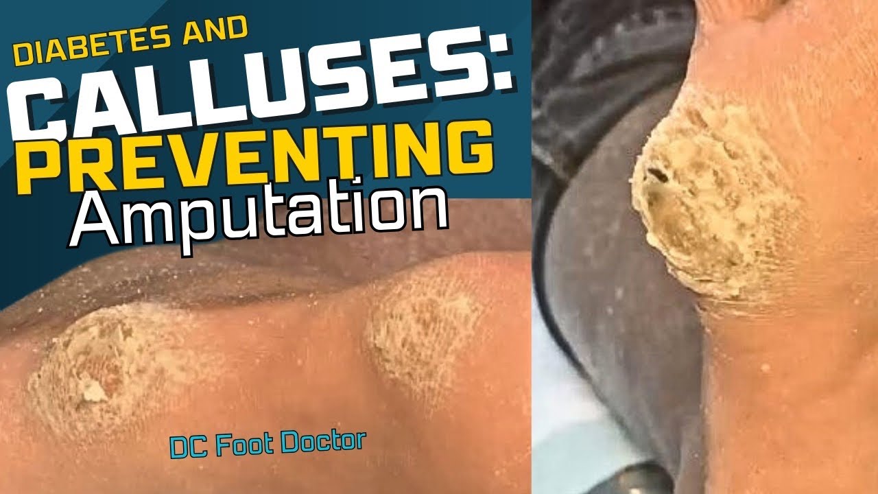 Diabetes and Calluses: Preventing Amputation - YouTube