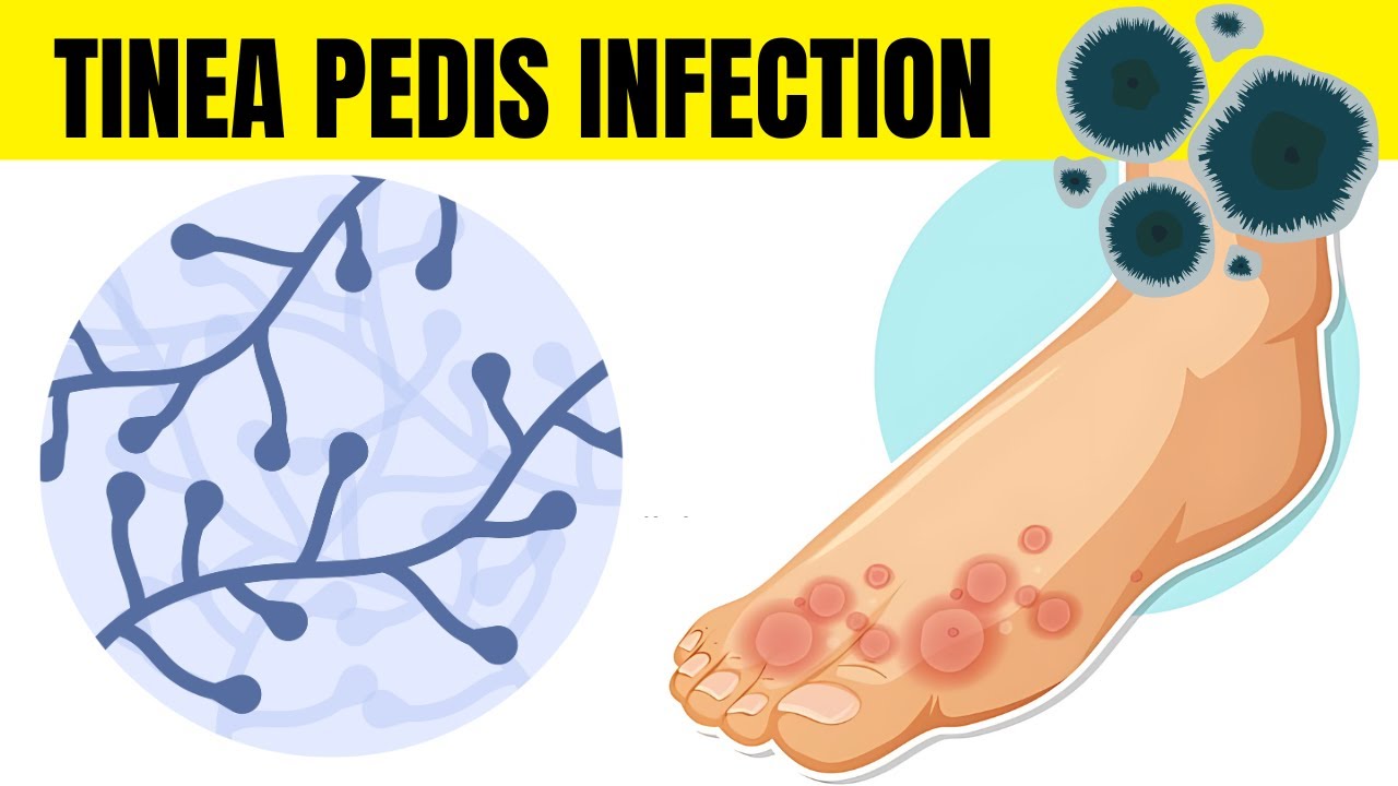 Tinea Pedis Infection (Athlete's Foot) - Causes, Types, Signs ...