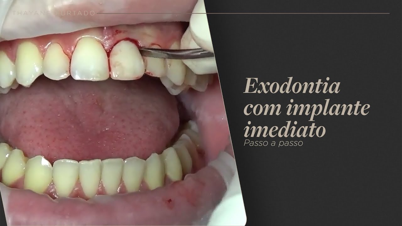 Passo a passo de exodontia e implante imediato | Dra. Thayane Furtado ...