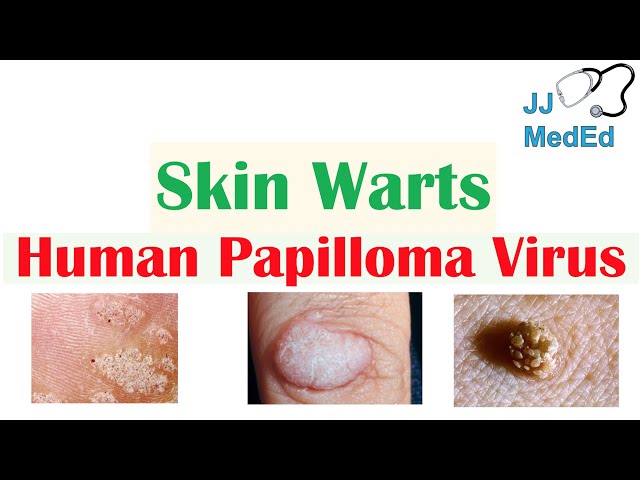 Viral Warts Symptoms