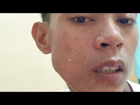 Tinanggal ko Libag ko Sa Mukha Gamit to?😱 - YouTube