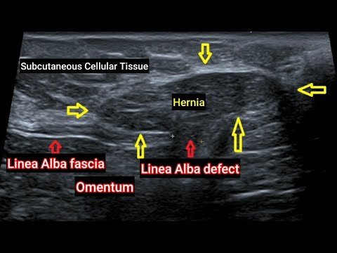 Linea Alba Hernia (Epigastric Hernia) Ultrasound - YouTube