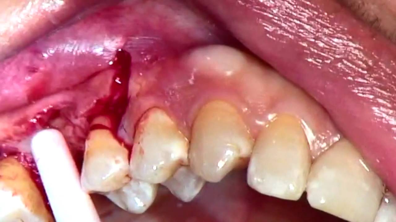 8th ITI week live surgery: lateral window sinus floor elevation. Part I ...