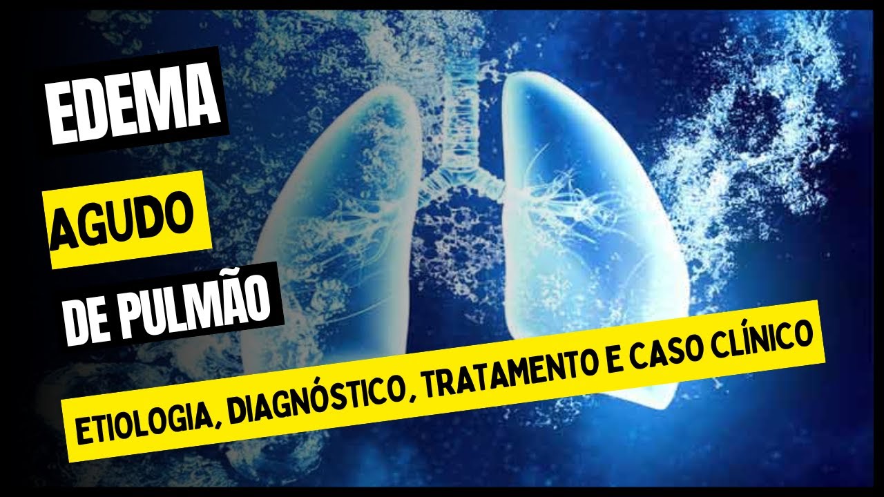 Edema agudo de pulmão - Etiologia, diagnóstico, tratamento e caso ...