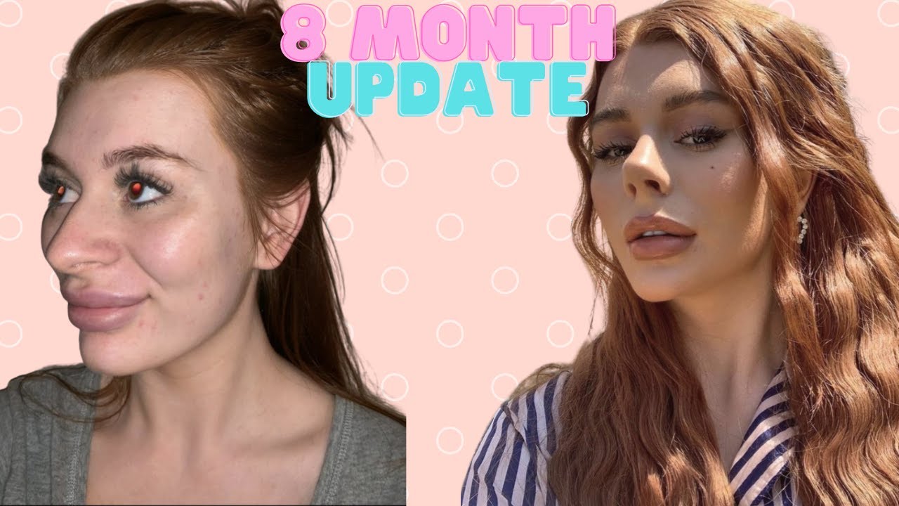 8 MONTH NOSE JOB UPDATE! | Antonia Higham - YouTube