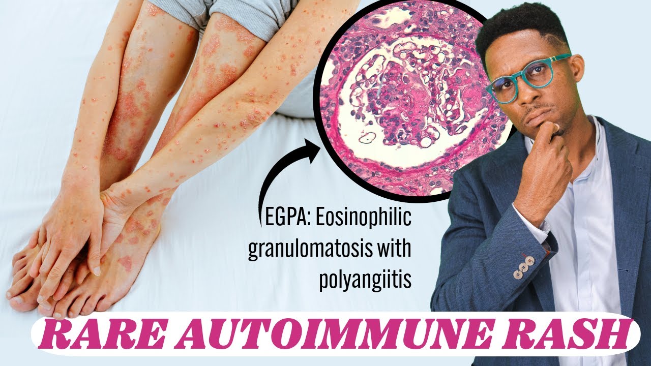 Eosinophils and lung disease: Let’s talk EGPA, an eosinophilic ...